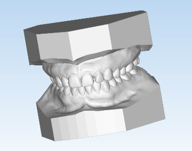 Study Models - Rodwell Orthodontic Laboratory - eDontics
