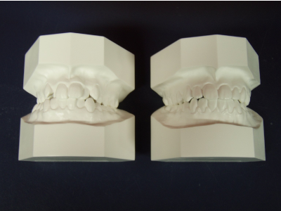 Study Models - Rodwell Orthodontic Laboratory - eDontics